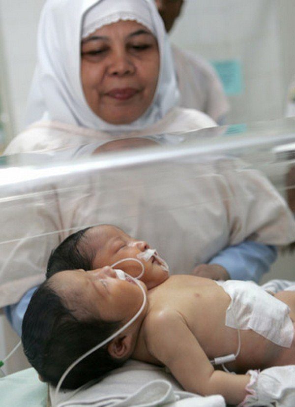 Baby Girl With Two Heads Born in Indonesia - Stay at Home Mum