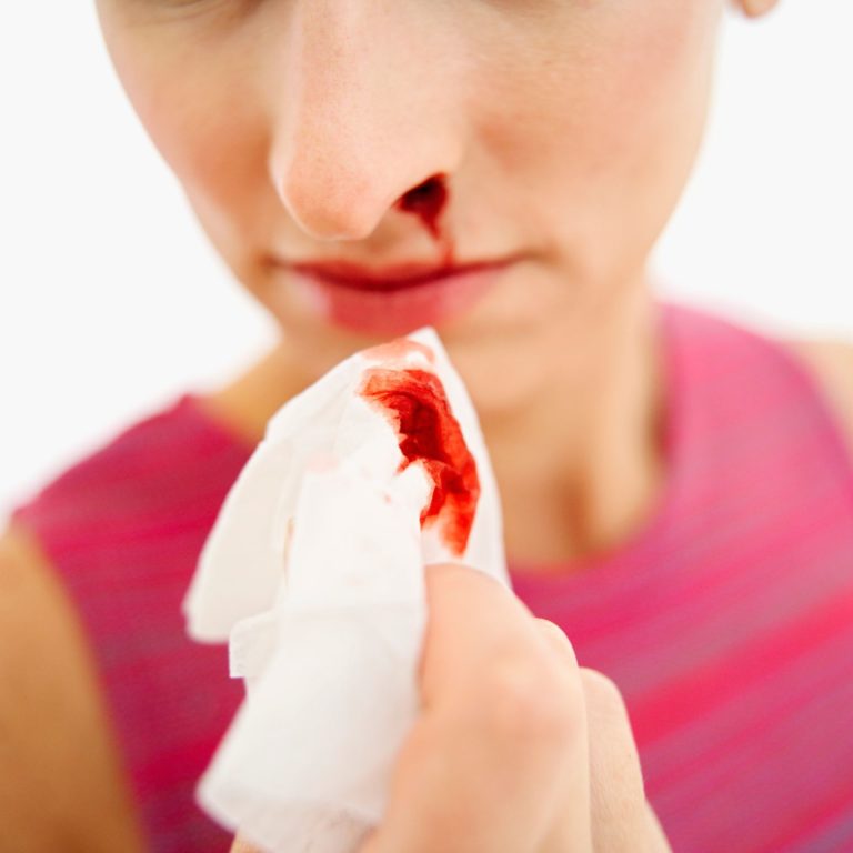 Everything You Need To Know About Nosebleeds - Stay at Home Mum